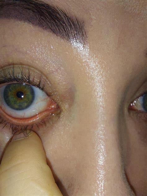 Dry Eye Or Infected Tear Duct Rdryeyes