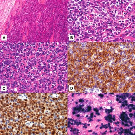 Pathophysiology Of Ebv Positive Dlbcl Of The Elderly Abbreviations