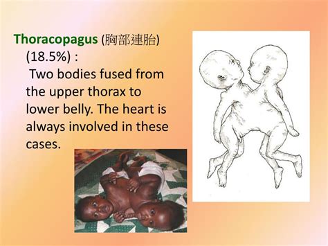 Ppt Conjoined Twins Powerpoint Presentation Free Download Id2703493