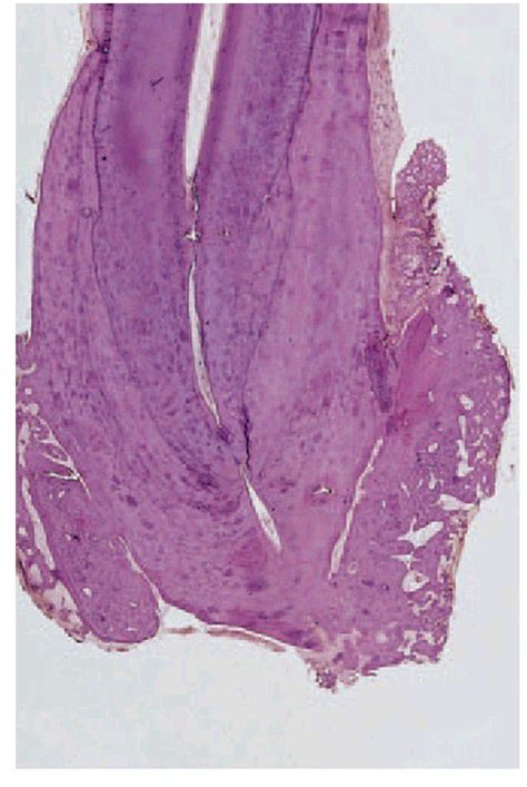 Hypercementosis In Pagets Disease Medizzy