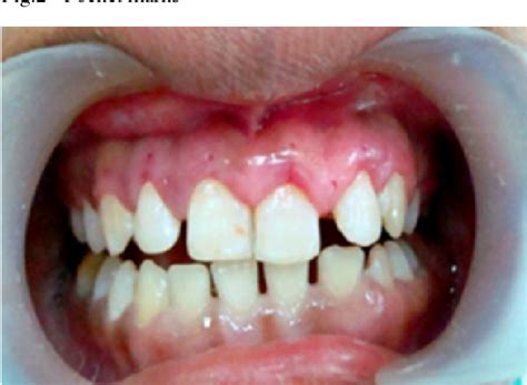 Figure 4 From Crown Lengthening Procedure With Internal Bevel