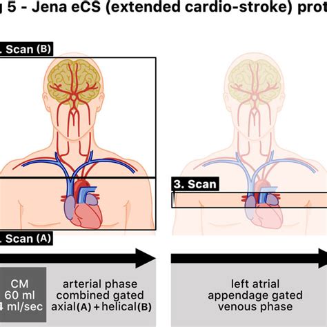 Novel Extended Ct Protocol In The Initial Ischemic Stroke Diagnostics