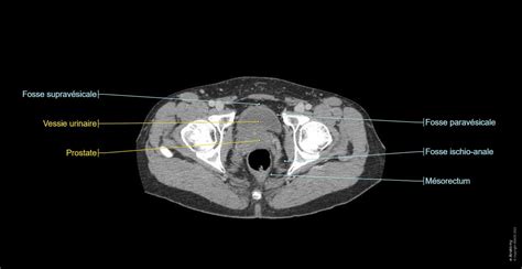 Abdomen Pelvis Anatomie Normale E Anatomy