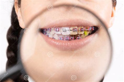 Close Up Of Young Caucasian Woman With Brackets On Dirty Teeth Result