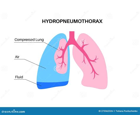 Hydropneumothorax Medical Poster Vector Illustration Cartoondealer