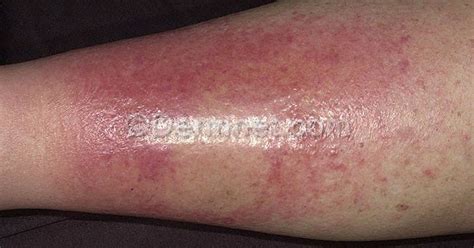 Celulitis Infecciosa ¿que Es La Celulitis Infecciosa