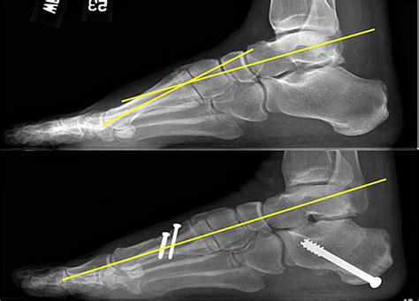 Surgical Technique For Combined Dwyer Calcaneal Osteotomy And Peroneal
