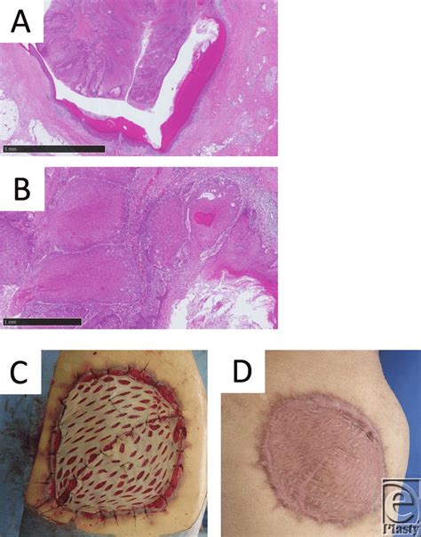 A Epithelial Findings The Epithelium Of The Squamous Cell Carcinoma Download Scientific