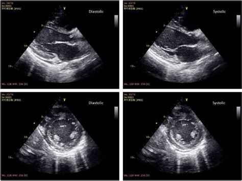 Systolic Function On Echocardiogram A Echocardiogram During The Download Scientific Diagram