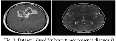 Figure 1 From Convolutional Neural Network Based Framework For Classification Of Brain Tumor