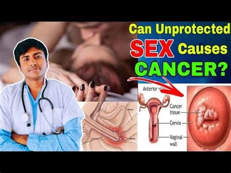 Unprotected Sex Cause Cancer In Private Part Vagina Cancer Cervical