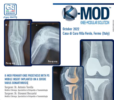 K Mod Primary Knee Prosthesis With Ps Mobile Insert Implanted On A Severe Varus Gonarthrosis