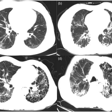 Summary Of Clinicopathologic Features Of The Ipf Patients Download Table