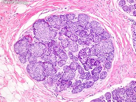 Lobular Carcinoma In Situ