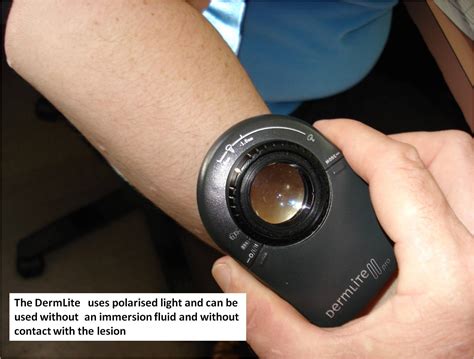 Introduction To Dermatoscopy