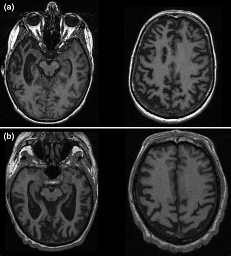 Behavioral Variant Of Frontotemporal Dementia The Brain Clinic