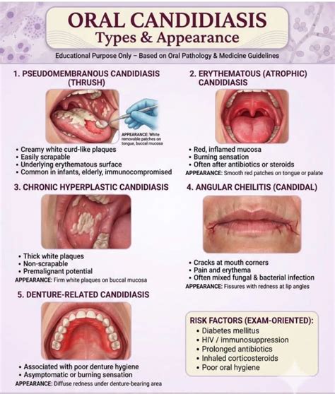 Oral Candidiasis Symptoms And Treatment Dr S0 Mikaye Posted On The
