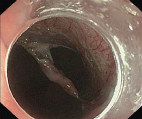 Estd Procedure A Lesion Under Light Endoscopy B Marking The