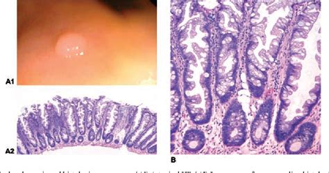 Hyperplastic Polyp Colon