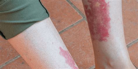 Vasculitis Vcs Symptoms Causes Types Diagnosis And Treatments