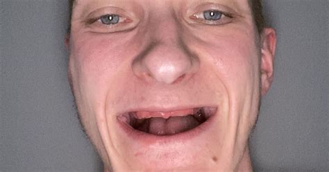 Man Hoping To Get New Smile And Find Love After Illness Made Him Lose