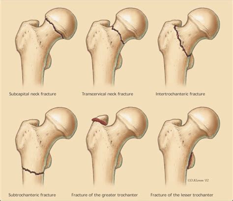 Bone Clinic And Neurosurgeon Contact Us 65 31381235 Hip Fracture