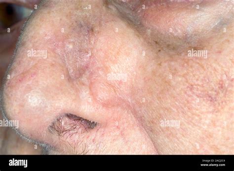 Basal Cell Carcinoma Nose