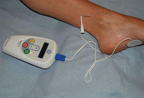 Implantable Chronic Tibial Nerve Modulation Springerlink