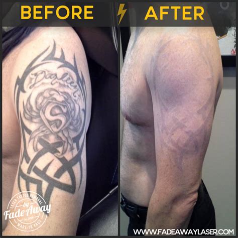 Portfolio Fade Away Laser