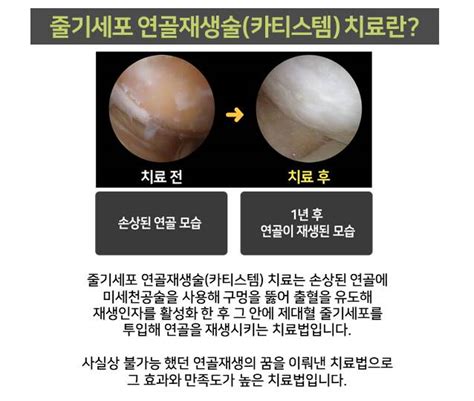 제대혈 줄기세포 연골재생술 카티스템치료 건강정보 조은마디병원