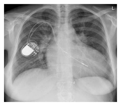 32 Year Old Patient With Severe Biventricular Dysfunction After Atrial