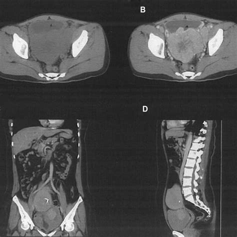 Case 1 A A Huge Multi Nodular Soft Tissue Mass 91 Â 84 Cm In