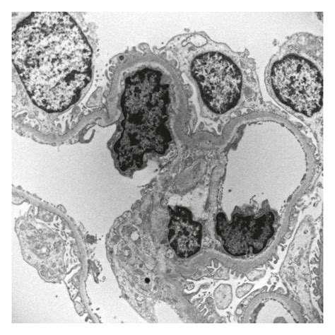 Renal Biopsy Findings A One Glomerulus Showing Segmental Download Scientific Diagram