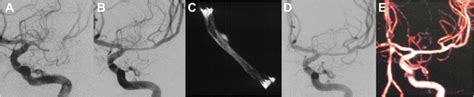 A 41 Year Old Man With A Severe Stenosis Of The M1 Segment Of The Left
