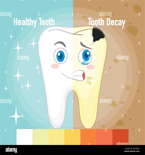 Infographic Of Healthy Tooth And Tooth Decay Illustration Stock Vector
