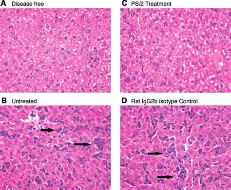 Ps 2 Treatment Reduced Myeloma Tumor Burden In The Liver Hande Stained