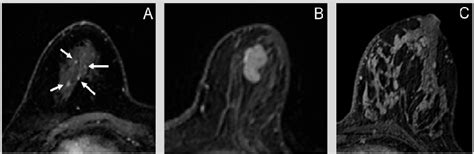 Examples Of Focus A Mass B And Segmental Clumped Nonmass Like