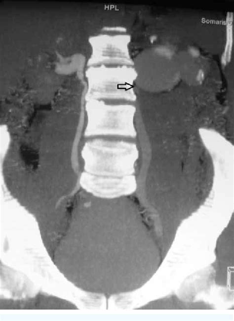 Figure 3 From A Case Of Trifid Pelvis With Ureteropelvic Junction