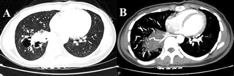 The Sequestrated Lung Located In The Right Lower Lobe Was Diagnosed Download Scientific Diagram