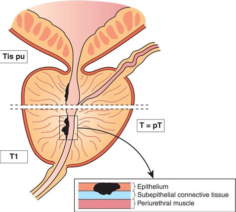 Urethra Oncohema Key
