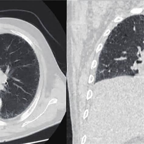 Computed Tomography Showed Atelectasis Of The Middle And Lower Lobe
