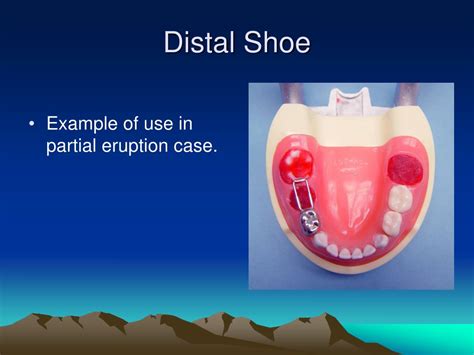 Dental Distal Shoe At Katherine Roosa Blog
