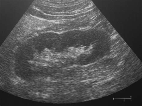 Renal Papillary Necrosis Ultrasound Papillary Necrosis Imaging
