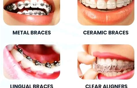 Different Options For Orthodontic Braces Dentist In Fairhope Al 36532