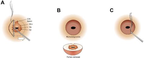 Management Of Cervical Dysplasia Using Office Loop Electrosurgical