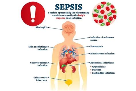 Surviving Sepsis North Mississippi Health Services