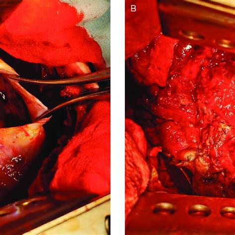 A Intraoperative Image Of Pleurectomy And Decortication B