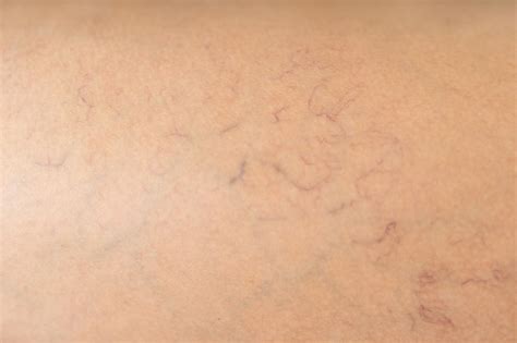 Premium Photo Varicose Veins Of Small Vessels On The Skin Of A Womans