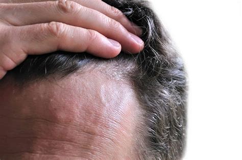 Dandruff Behind Ears At Ada Tawney Blog