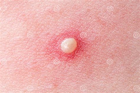 Brughiera O Comodone Brufoli Infiammati Cisti Delle Pustole Infezione